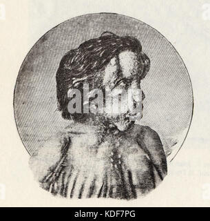 Joseph Merrick 1886 3 Stock Photo - Alamy