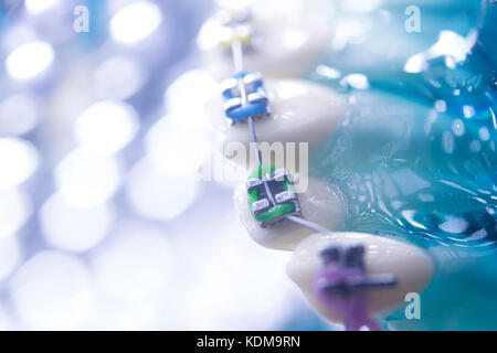 Dental teeth retainers metal aligners brackets to straighten teeth in ...