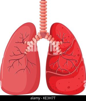 Lung diagram of pneumonia illustration Stock Vector Image & Art - Alamy