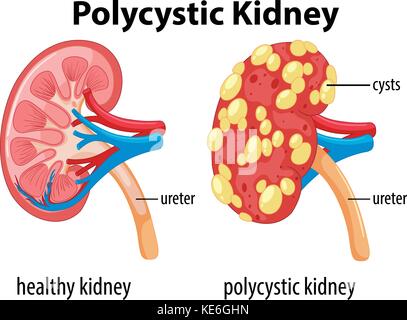 Diagram showing human polycystic kidney disease illustration Stock ...