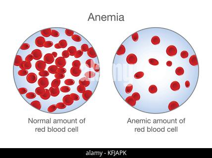 The difference of normal amount of red blood cell and Anemia Stock ...