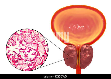 Benign prostatic hyperplasia, illustration Stock Photo - Alamy
