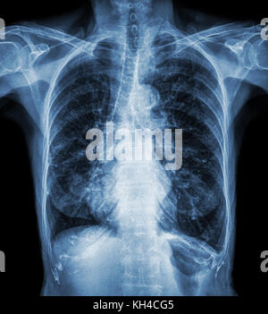 Normal chest X-ray of old patient . You can seen calcification at rib ...