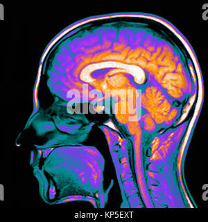 Coloured magnetic resonance imaging (MRI) scan of a sagittal section through a patient's head ...
