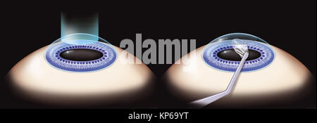 Laser surgery for myopia (short-sightedness), Nurse, Centre François ...