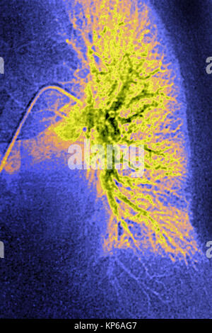PULMONARY EMBOLISM, X-RAY Stock Photo - Alamy