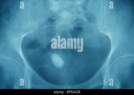 VESICAL CALCULUS, X-RAY Stock Photo - Alamy