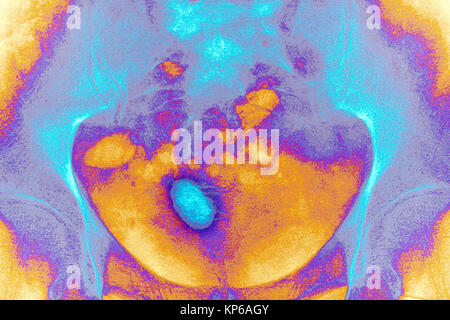 VESICAL CALCULUS, X-RAY Stock Photo - Alamy