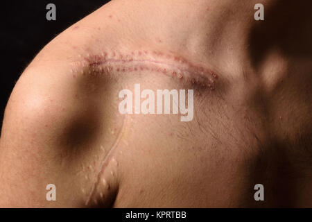 detail of a scar on the clavicle Stock Photo - Alamy