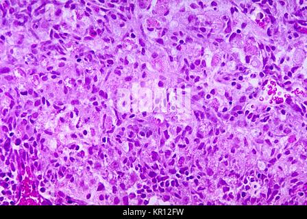 Photomicrograph of histopathologic changes in a case of botryomycosis ...