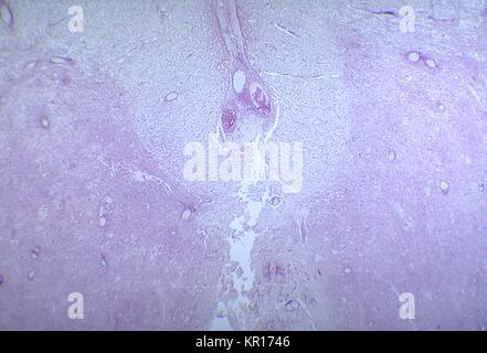 A photomicrograph of the lumbar spinal cord depicting an infarct due to ...