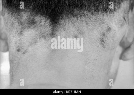 A photograph of a patient with tertiary syphilis resulting in gummatous ...