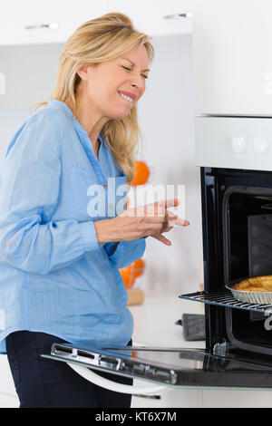 kitchen burn on hand caused by heating oven Stock Photo - Alamy