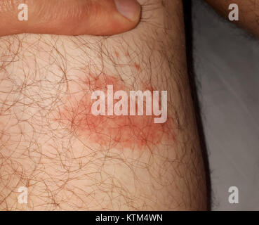 Atypical erythema migrans 1 week after initial presentation Stock Photo ...