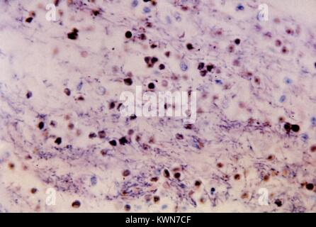 Anthrax bacteria. Light micrograph of anthrax bacteria (Bacillus ...