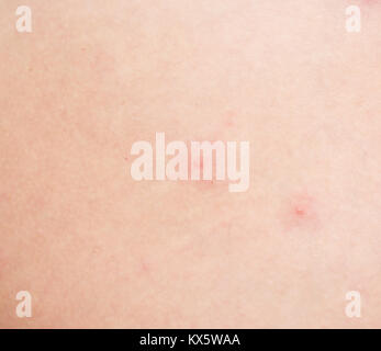 Chickenpox rash. Close-up of a rash on the chest of a 5-year-old male ...
