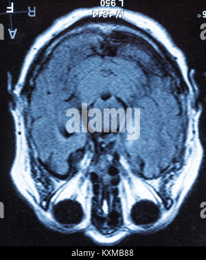 Head MRT. MR image of human brain Stock Photo - Alamy