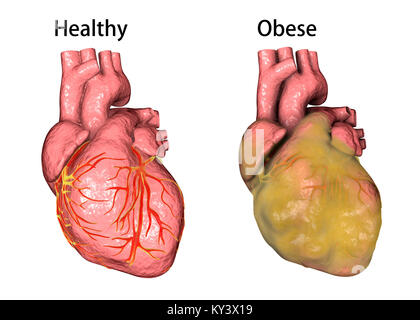 Computer illustration of a fatty heart and a coronary artery narrowed ...