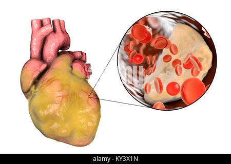 Computer illustration of a fatty heart and a coronary artery narrowed ...