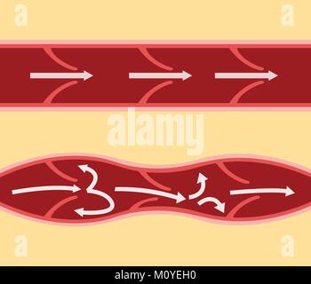VENOUS DISEASE Varicose Veins Of Human Legs Twisting And Dilation Of ...