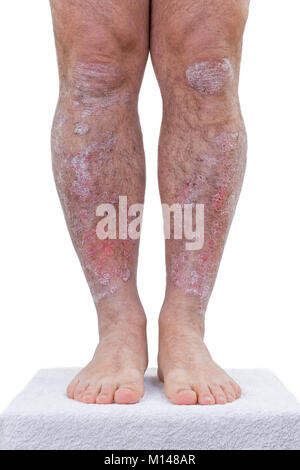 Psoriasis is a chronic inflammatory disease of the skin. Detail of ...