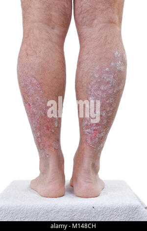 Psoriasis is a chronic inflammatory disease of the skin Stock Photo ...
