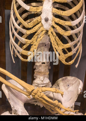 The skeleton of Peter Cluckey who died of chronic rheumatism on display ...