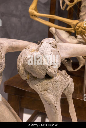 The skeleton of Peter Cluckey who died of chronic rheumatism on display ...