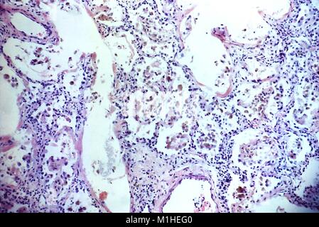 Staphylococcus aureus bacteria, light micrograph. These Gram-positive ...