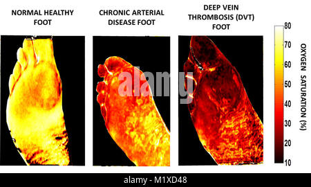 SFDI surgical camera images show reconstruction skin flaps with normal ...