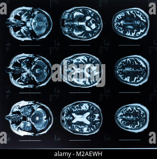 Head MRT. MR image of human brain Stock Photo - Alamy
