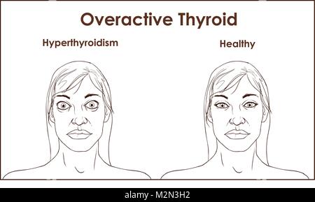 Face of an adult female exhibiting the symptoms of hyperthyroidism ...