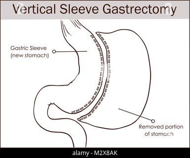 Vertical Sleeve Gastrectomy. Human stomach anatomy isolated on white ...