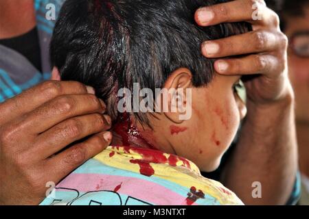 Child head injury in anti India protest, baramulla, Kashmir, India ...