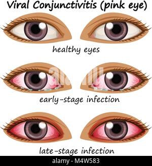 Human eye disease with viral conjunctivitis illustration Stock Vector ...