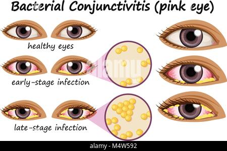 Diagram showing bacterial conjunctivitis in human eye Stock Vector ...