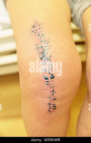 Surgical operation knee arthroscopy micro surgery on knee, tendon ...