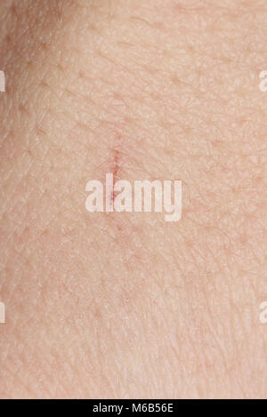 Scratch on a human skin on a white background Stock Photo - Alamy
