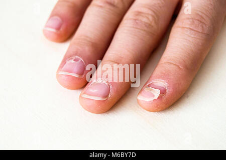 nail re-emergence in children, hand foot disease and nail health, nail ...