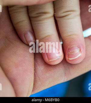 nail re-emergence in children, hand foot disease and nail health, nail ...