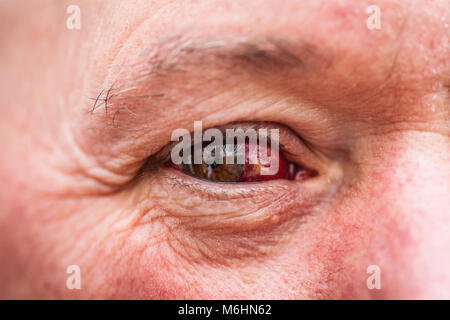 Bloodshot eye caused by an industrial accident. Cut to the pupil is ...
