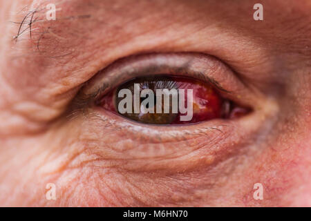 Bloodshot eye caused by an industrial accident. Cut to the pupil is ...