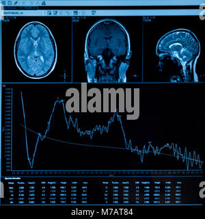 Close-up of MRI scan report Stock Photo - Alamy