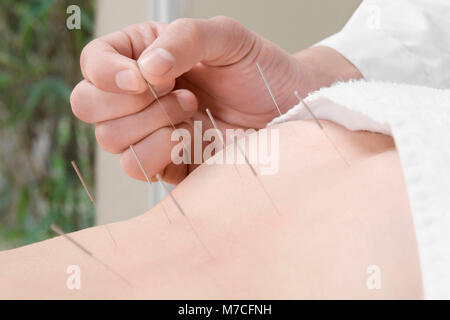 Acupuncturist applying needles on a person's back Stock Photo - Alamy
