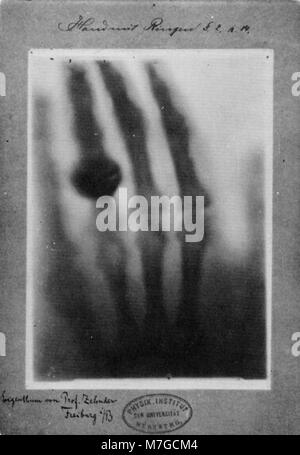 First medical X-ray by Wilhelm Röntgen of his wife Anna Bertha Ludwig's ...