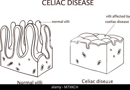 Coeliac disease or celiac disease. small bowel showing coeliac disease ...