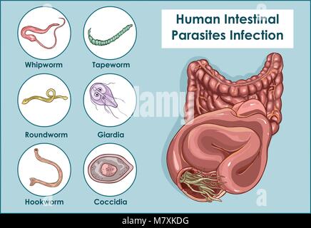 Vector Illustration of a Human Intestinal Parasites, worm disease Stock ...