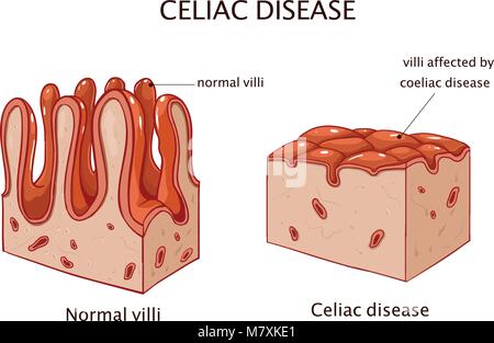 Coeliac disease or celiac disease. small bowel showing coeliac disease ...
