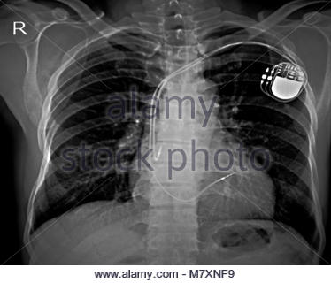 Chest x-ray with valve and pacemaker Stock Photo: 65488334 - Alamy