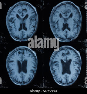 Head MRT. MR image of human brain Stock Photo - Alamy